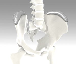 A new plastic surgery technique for hip widening | Gender Analysis