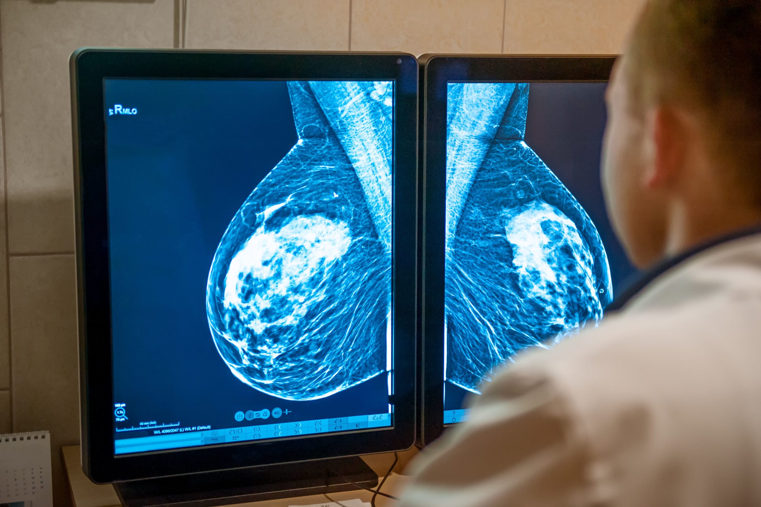 The Trans Mammogram Gap: Large numbers of trans people aren’t receiving ...